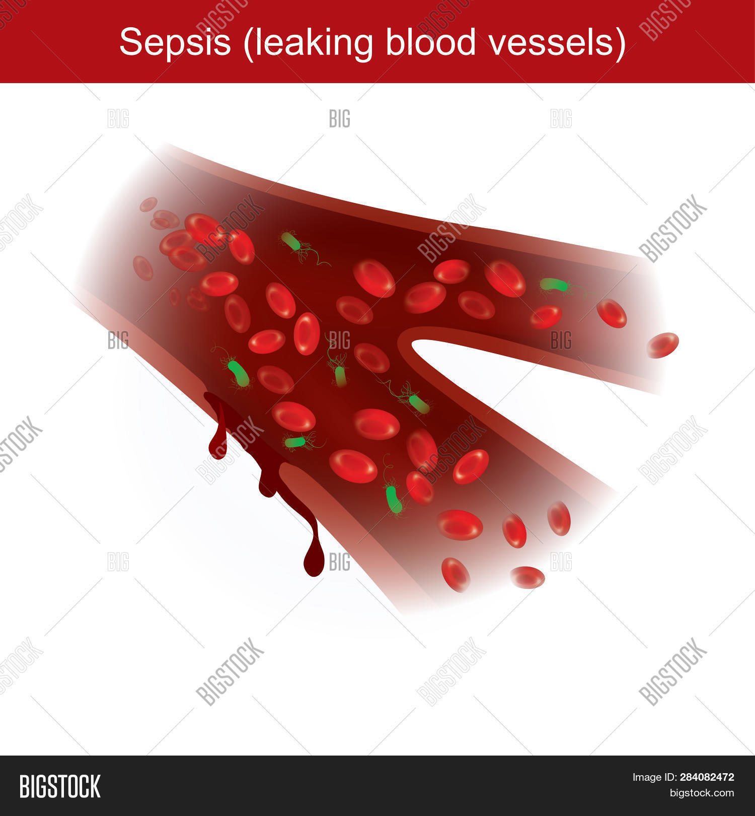 Sepsis. When Body Has Image & Photo (Free Trial) | Bigstock