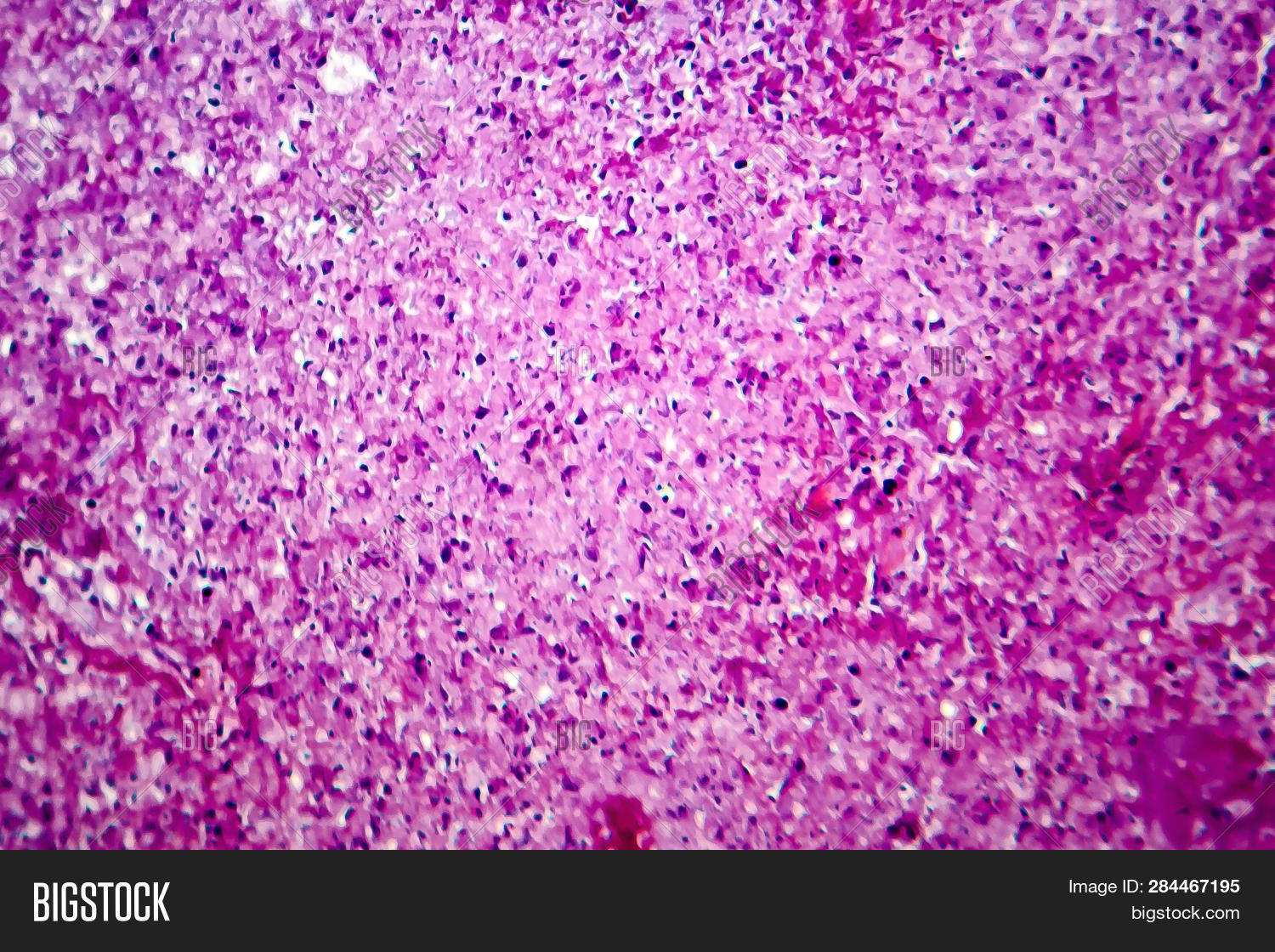 Caseation Human Image & Photo (Free Trial) | Bigstock