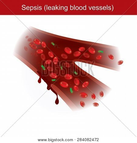 Sepsis. When Body Has Image & Photo (Free Trial) | Bigstock