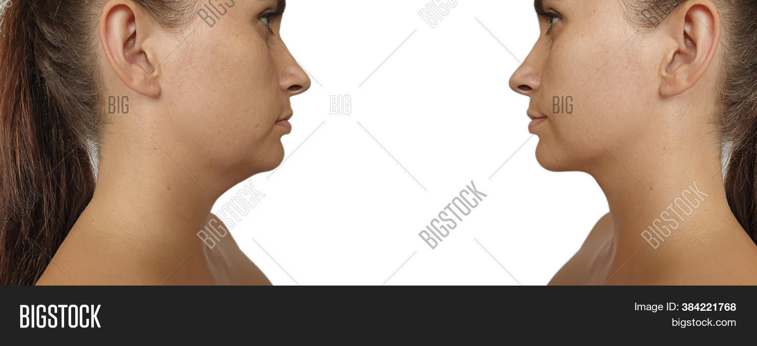 Woman Double Chin Image & Photo (Free Trial) | Bigstock