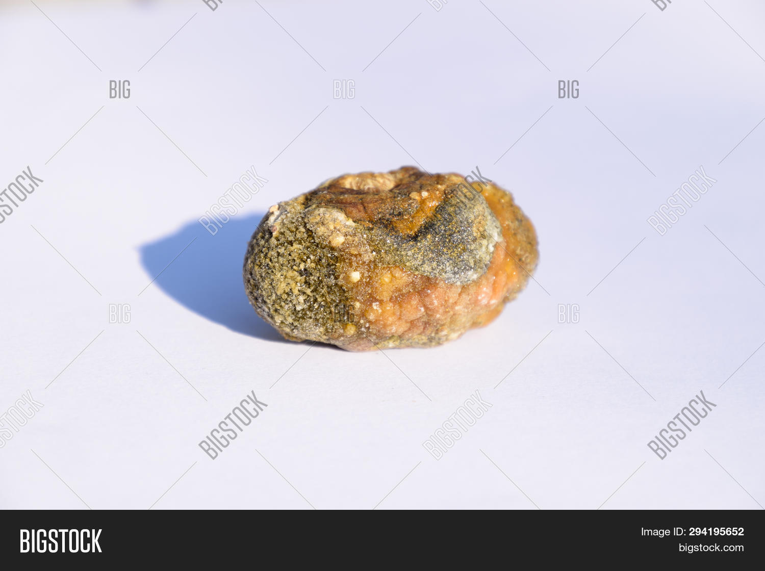 Stone Gallbladder. Image & Photo (Free Trial) | Bigstock