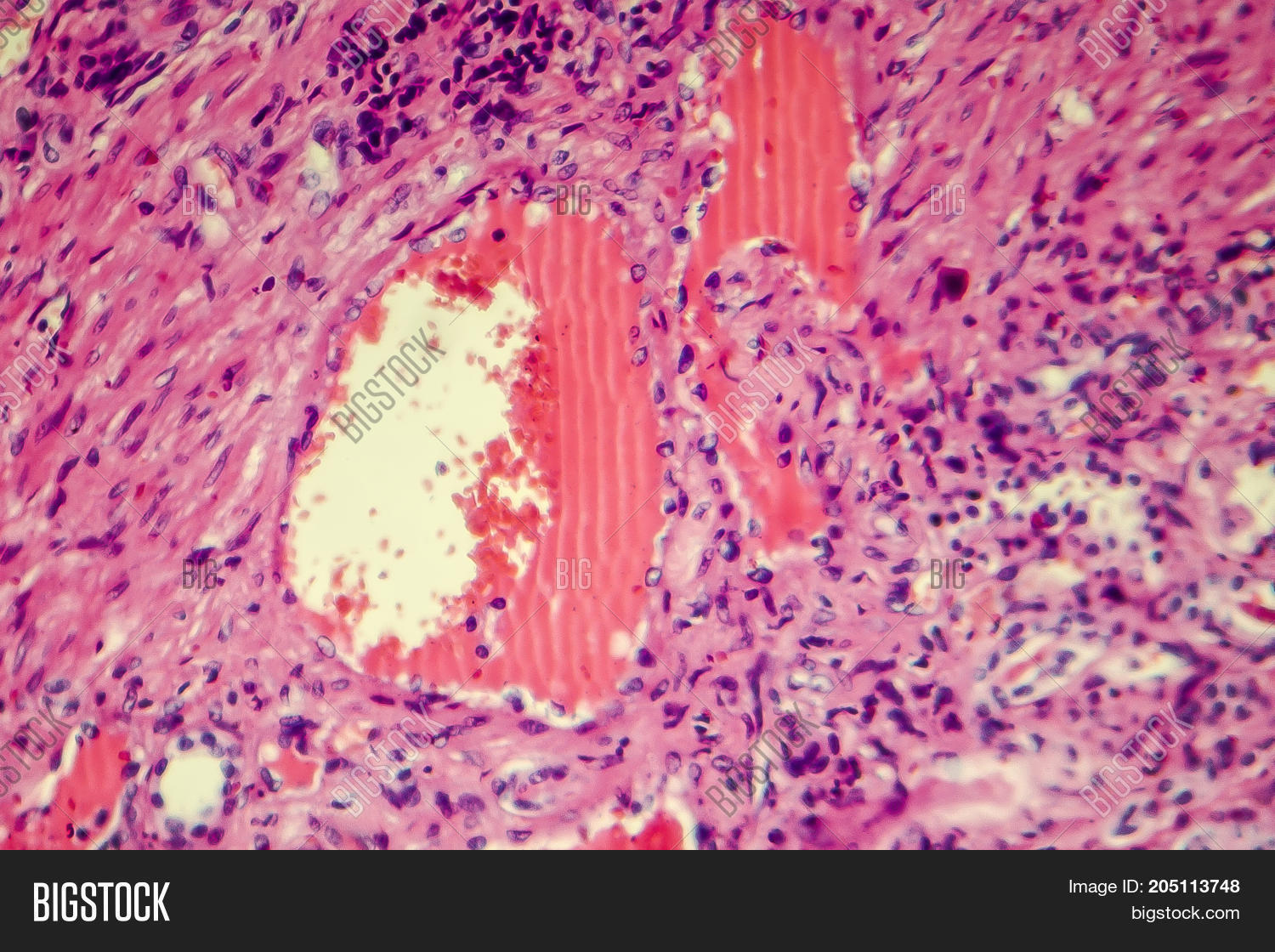Hyaline Degeneration Image & Photo (Free Trial) | Bigstock