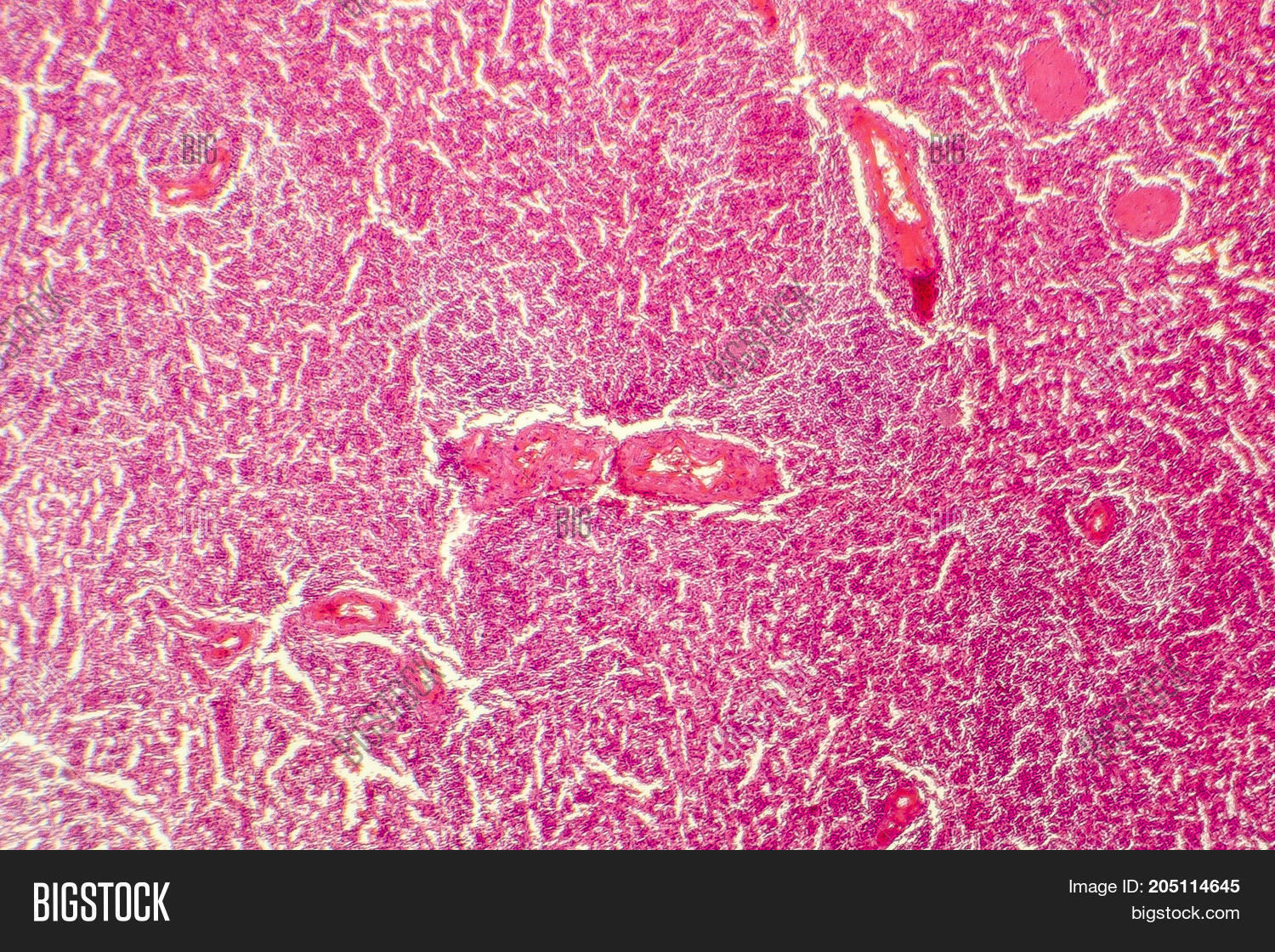 Hyaline Degeneration Image & Photo (Free Trial) | Bigstock