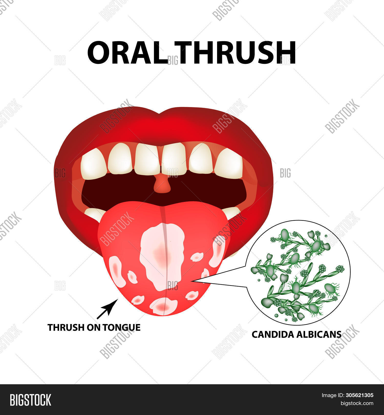 Oral Thrush. Image & Photo (Free Trial) | Bigstock