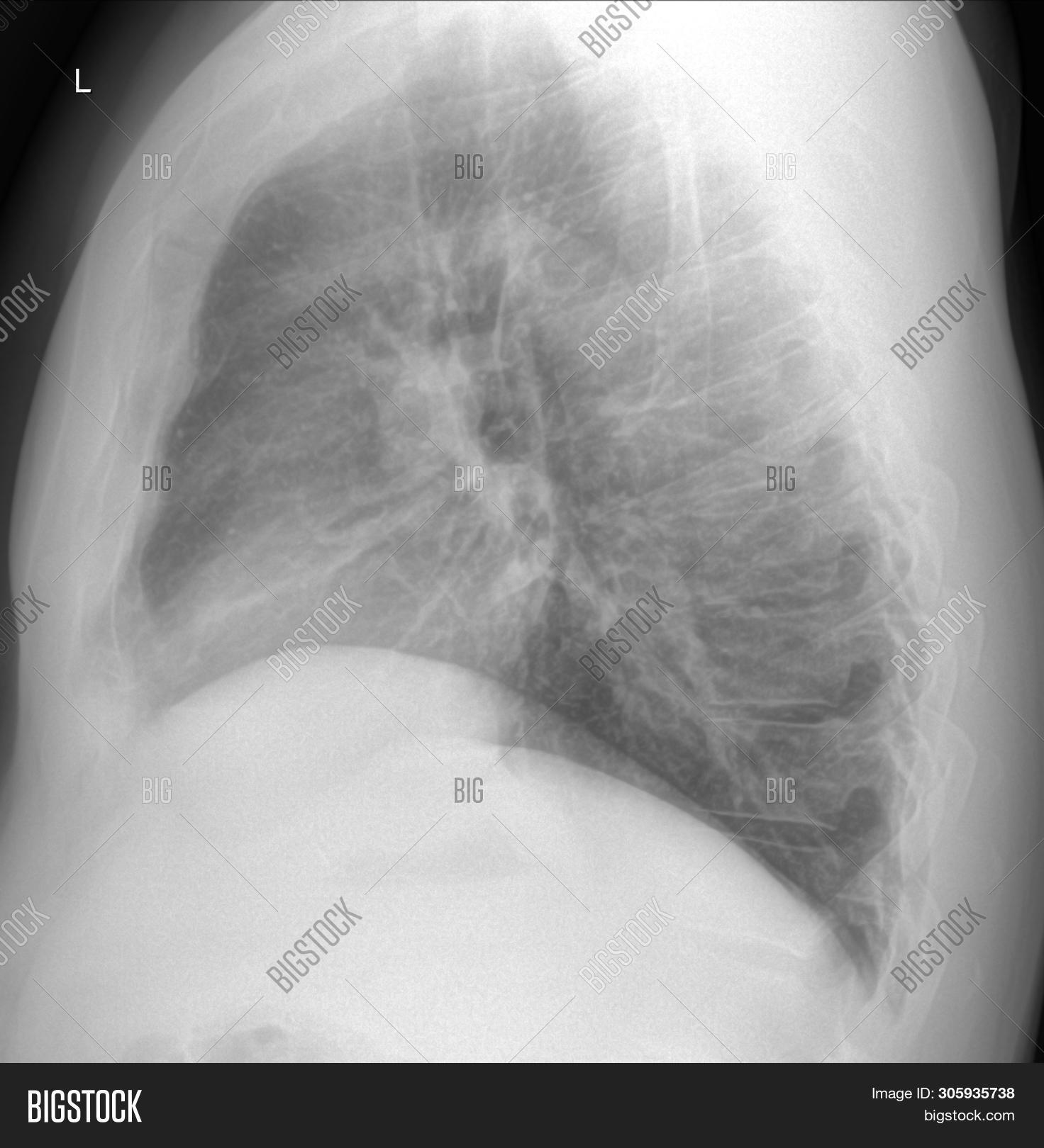 X-ray Scan Male Smoker Image & Photo (Free Trial) | Bigstock