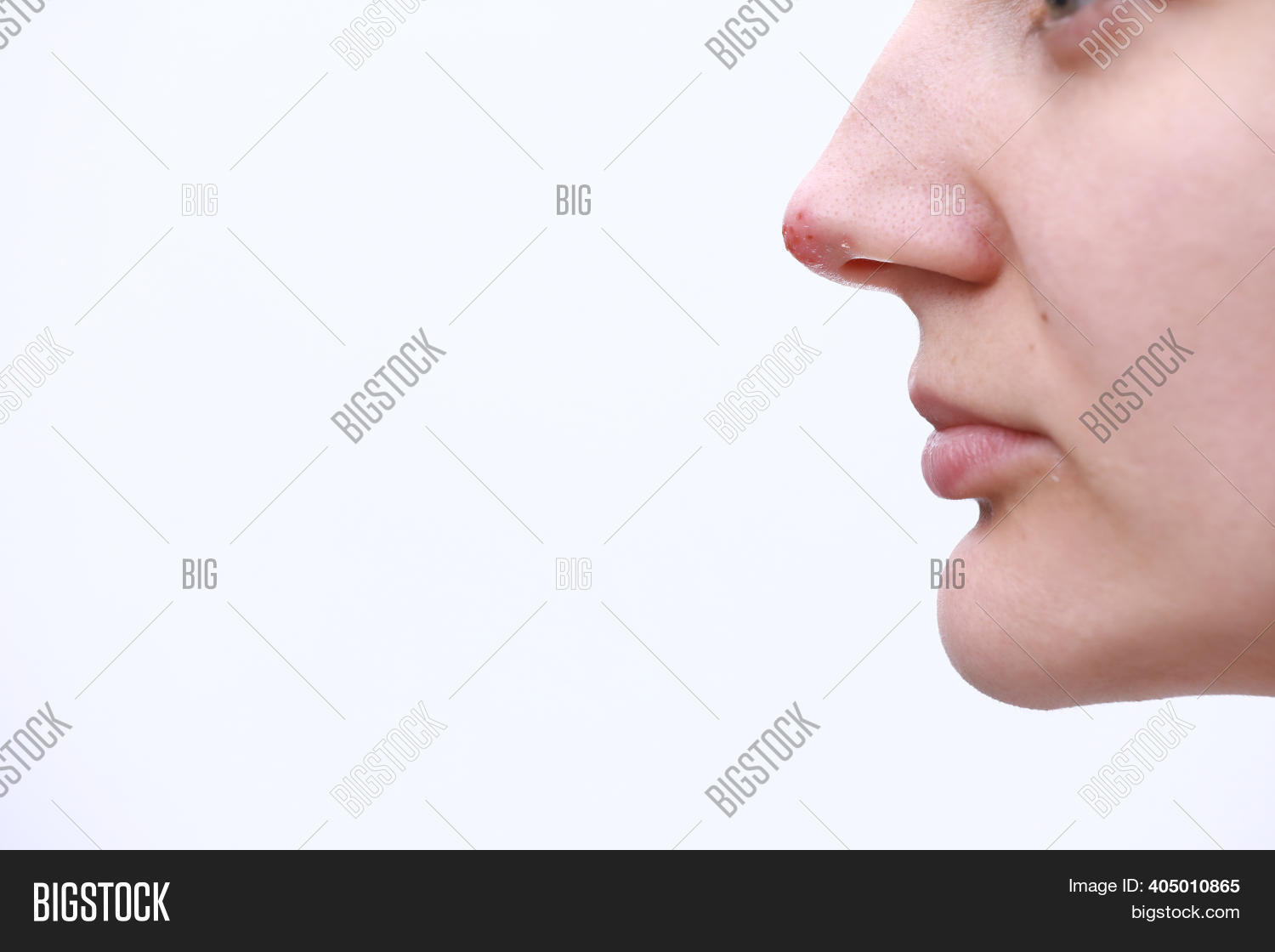 Herpes On Nose - Image & Photo (Free Trial) | Bigstock