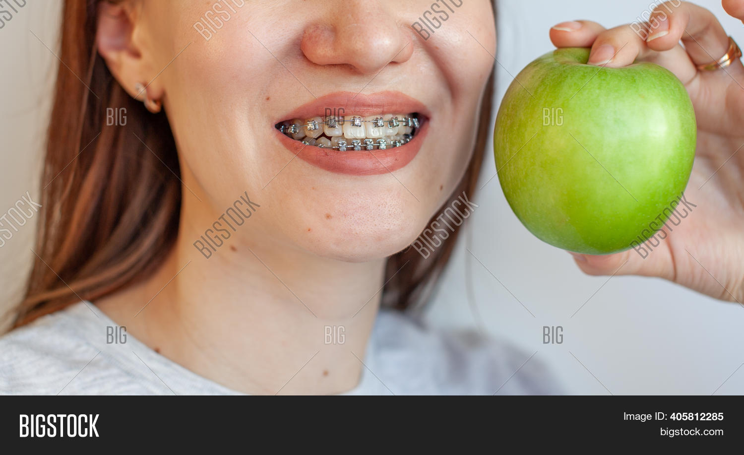 Girl Braces On Her Image And Photo Free Trial Bigstock