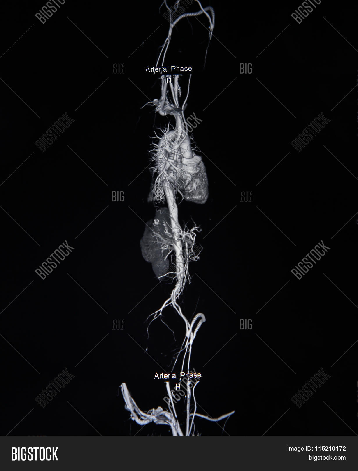 Ct Scan Angiogram ( Image & Photo (Free Trial) | Bigstock