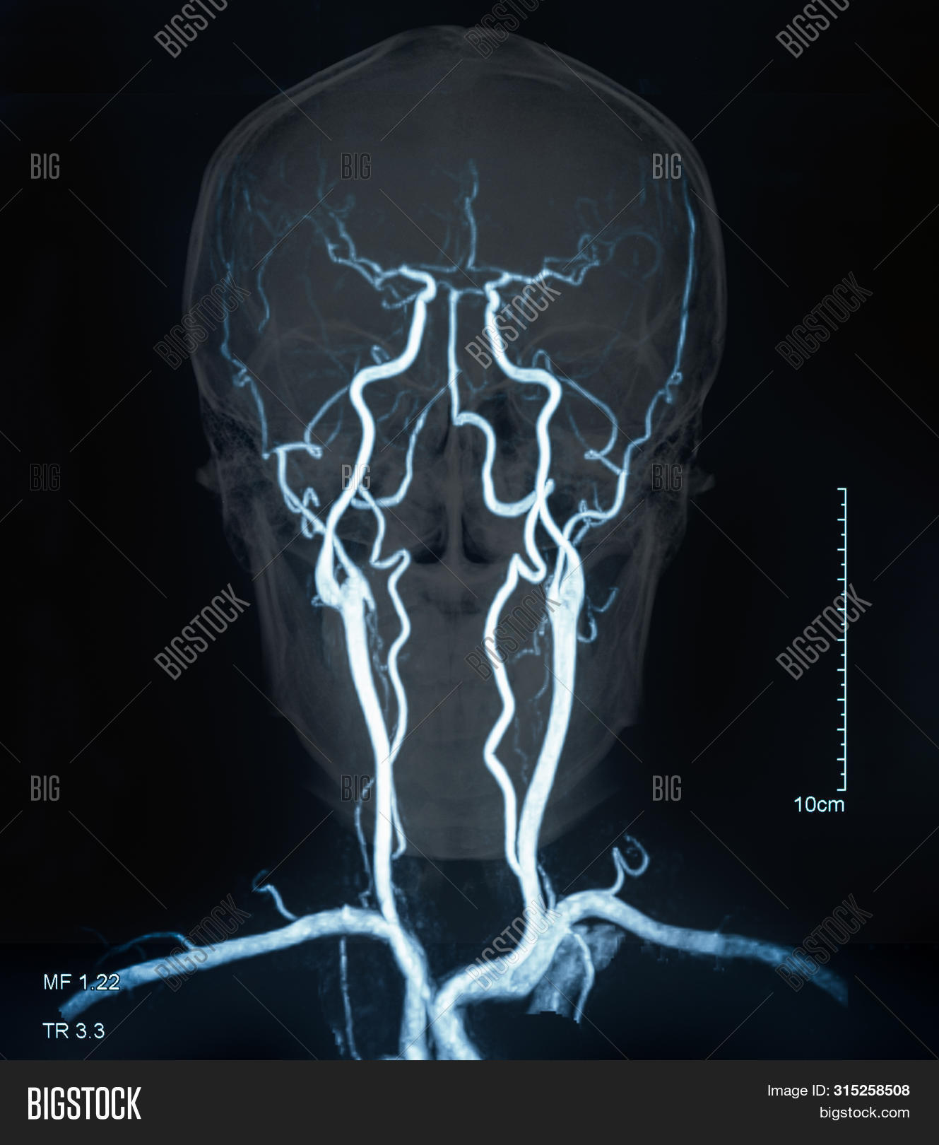 Mri Blood Vessels Image & Photo (Free Trial) | Bigstock