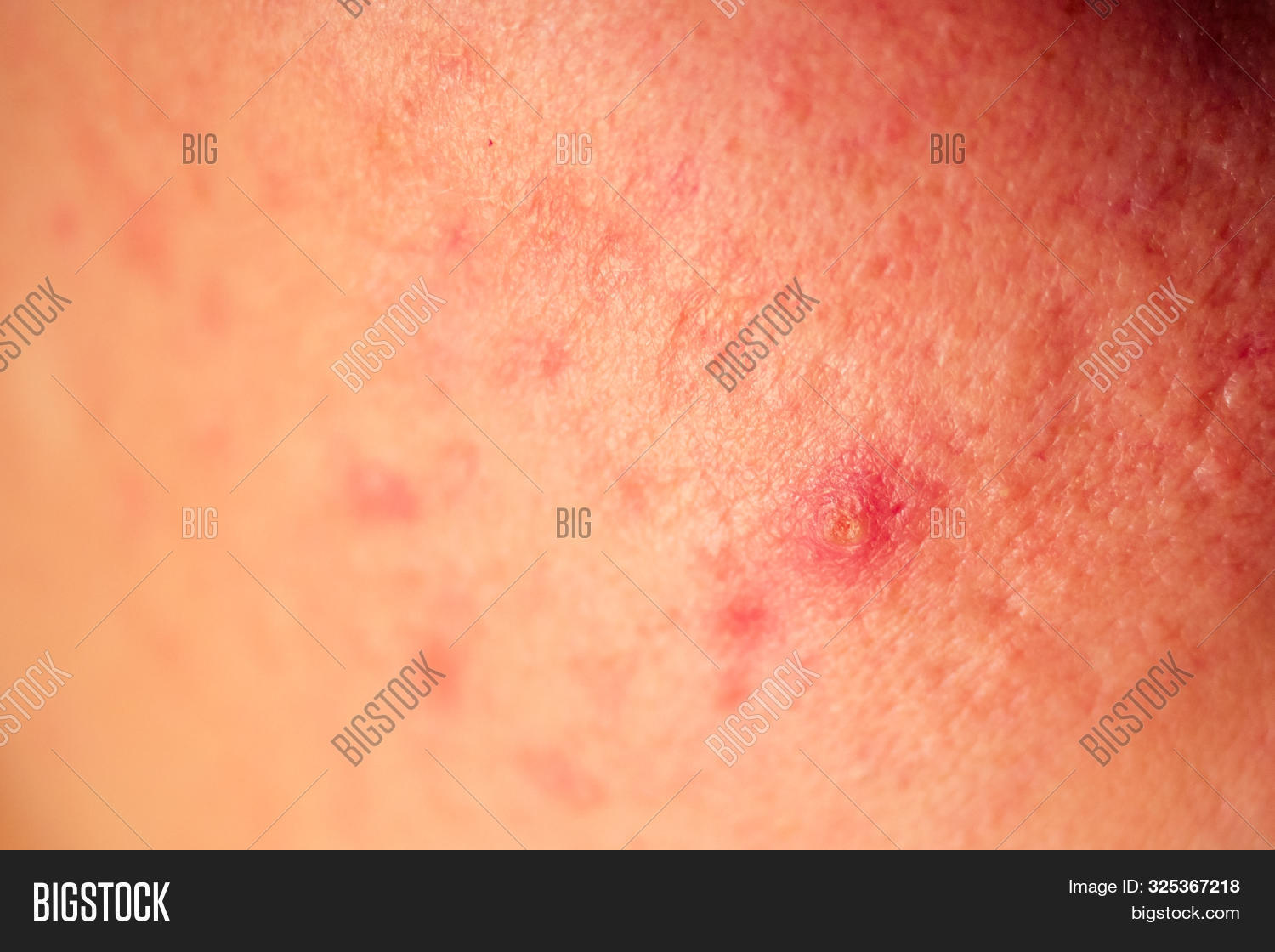 Post-acne, Scars Red Image & Photo (Free Trial) | Bigstock