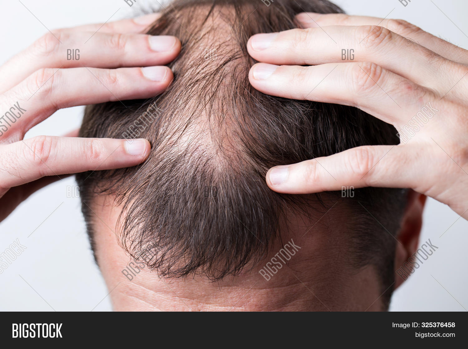 Close- Balding Head Image & Photo (Free Trial) | Bigstock