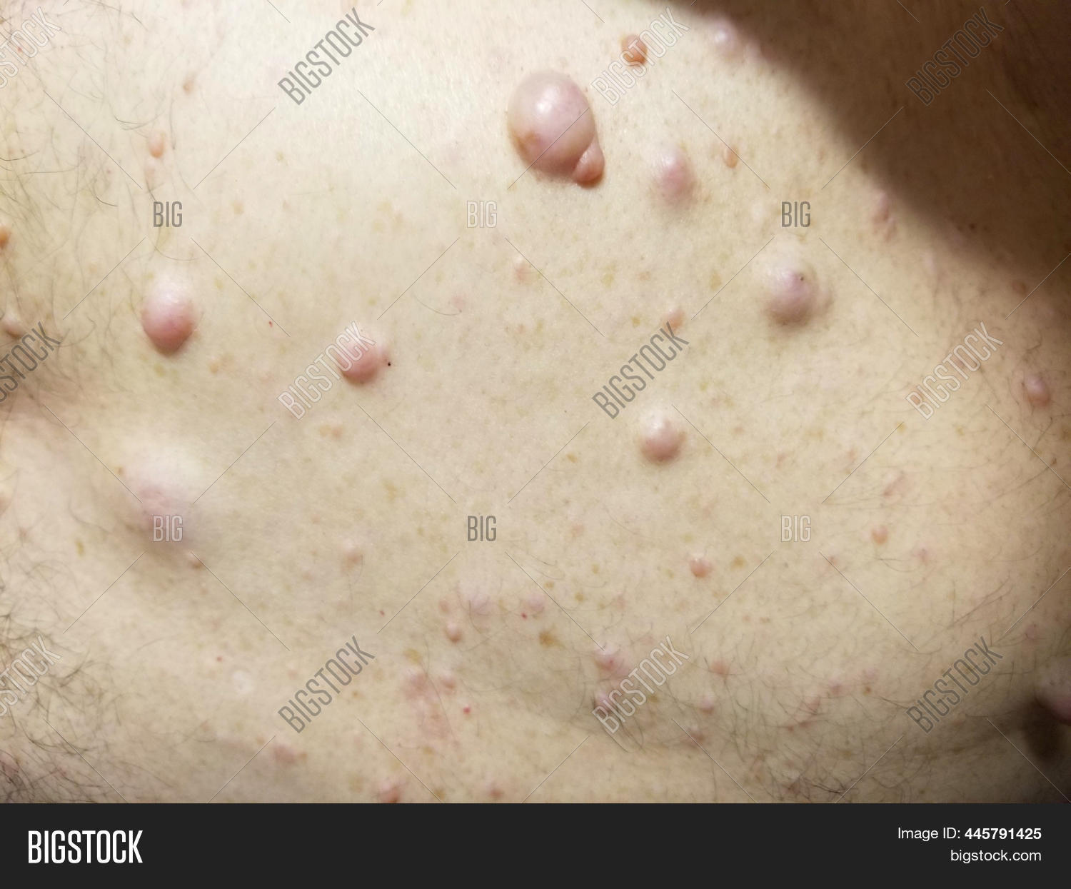 Skin Lesions Image & Photo (Free Trial) | Bigstock