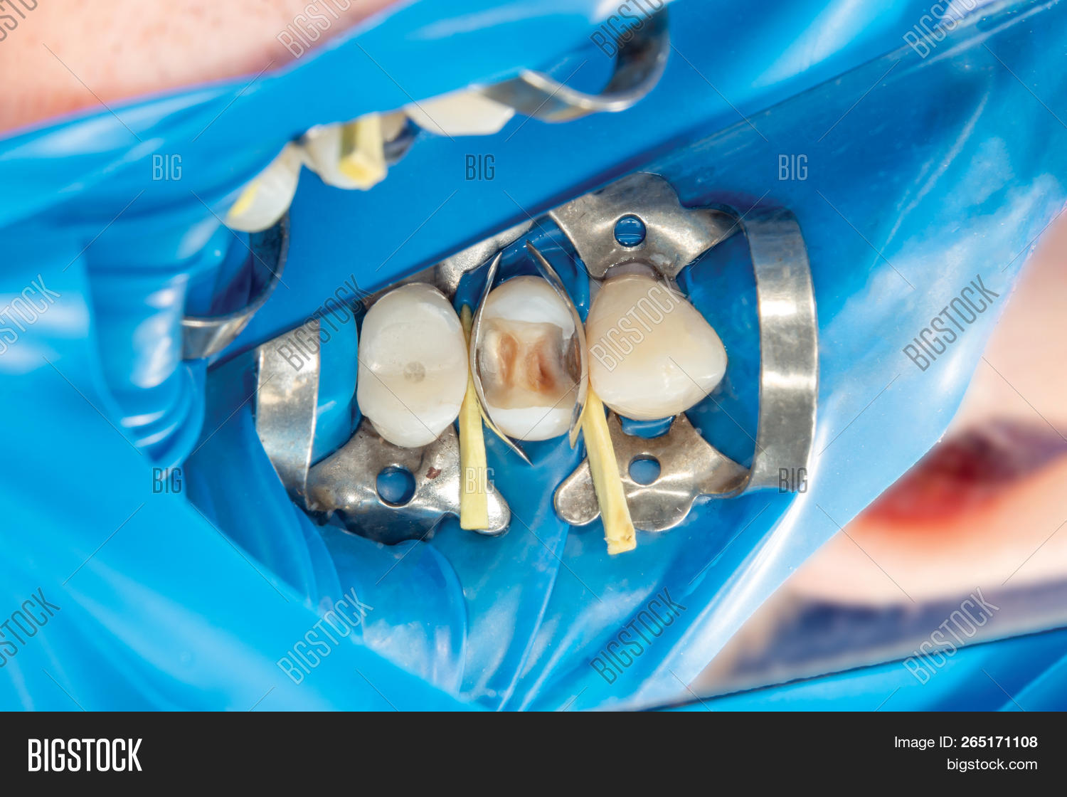Two Chewing Side Teeth Image & Photo (Free Trial) | Bigstock
