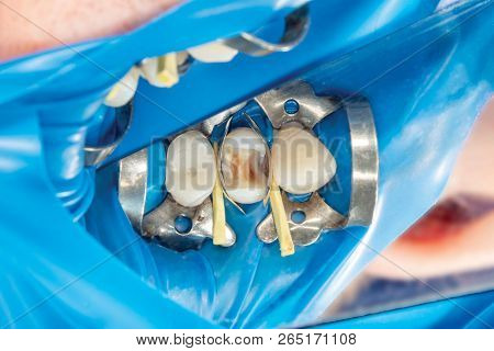 Two Chewing Side Teeth Image & Photo (Free Trial) | Bigstock