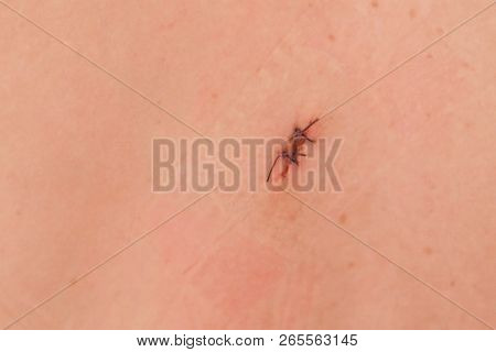 Stitched Wound Back. Image & Photo (Free Trial) | Bigstock