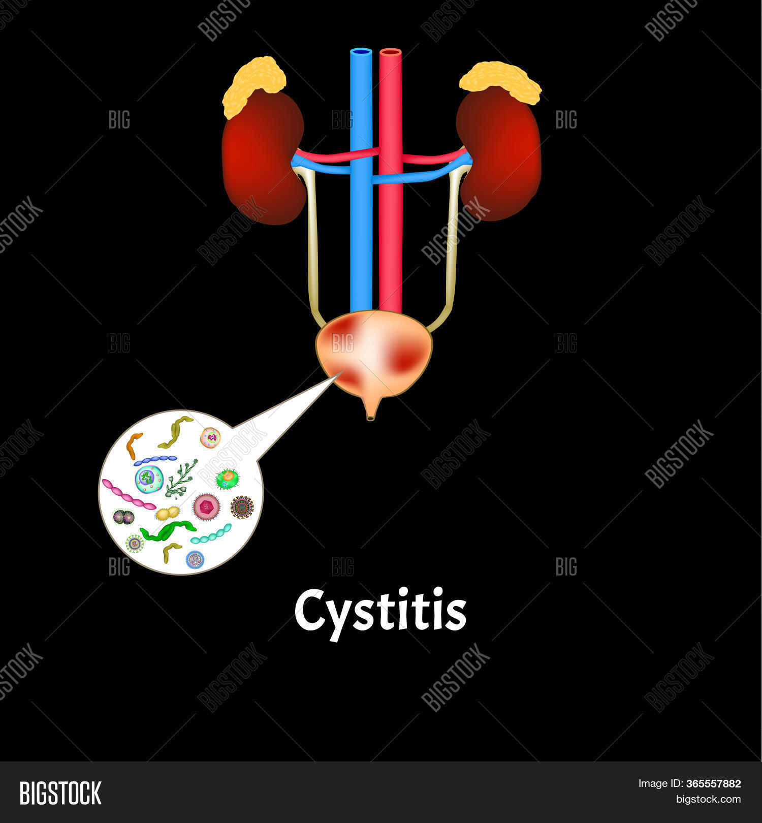 Cystitis. Inflammation Image & Photo (Free Trial) | Bigstock