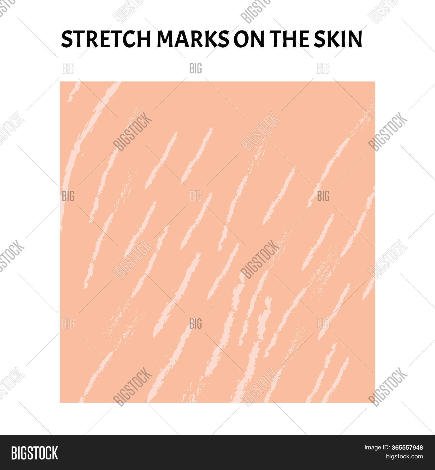 Stretch Marks On Skin Image & Photo (Free Trial) | Bigstock