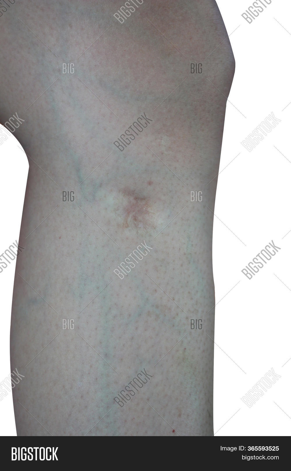 Scars On Skin Around Image & Photo (Free Trial) | Bigstock