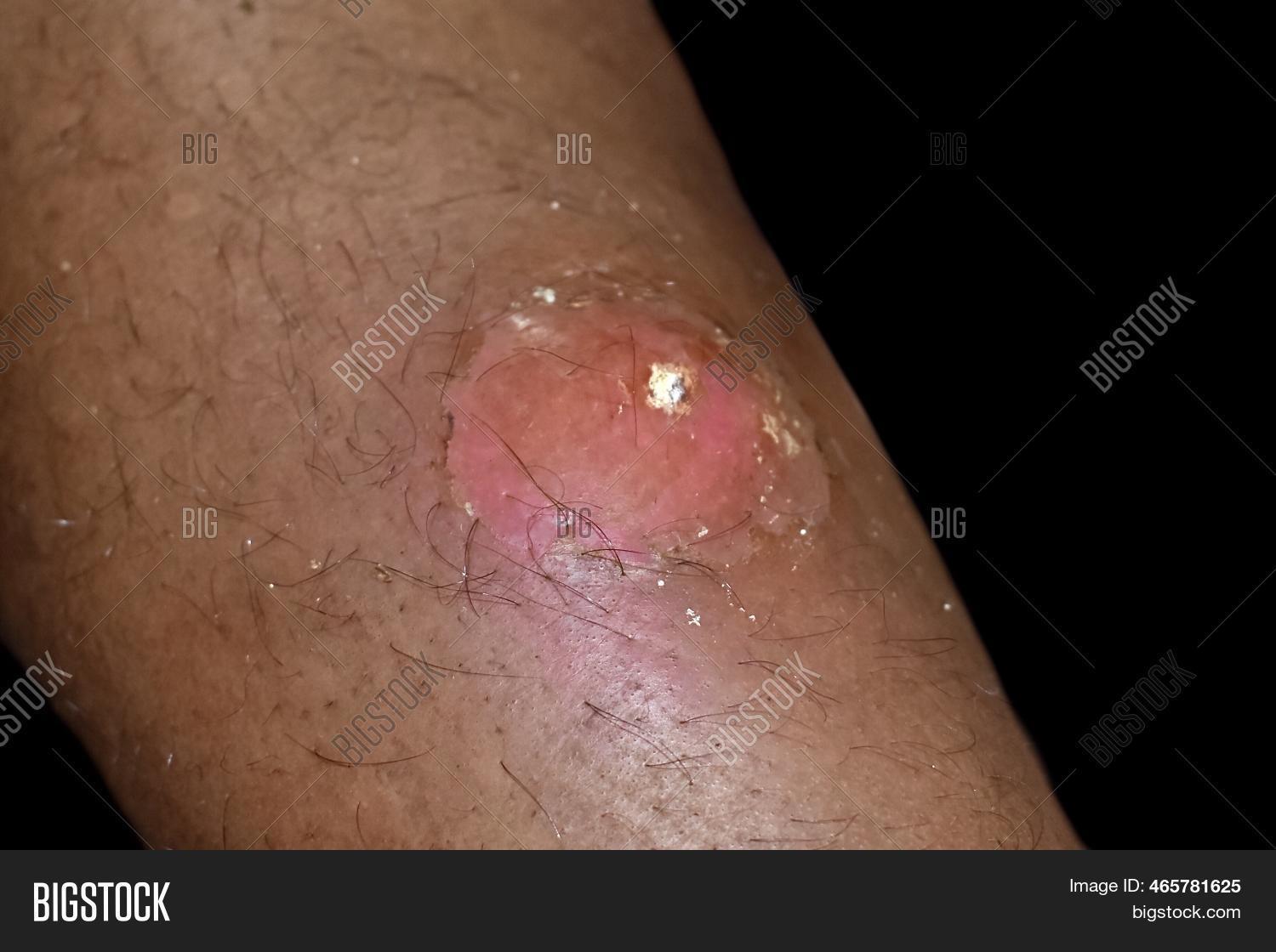 Impending Abscess Image & Photo (Free Trial) | Bigstock