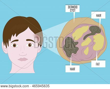 Dermoid Cysts Symptoms Image & Photo (Free Trial) | Bigstock