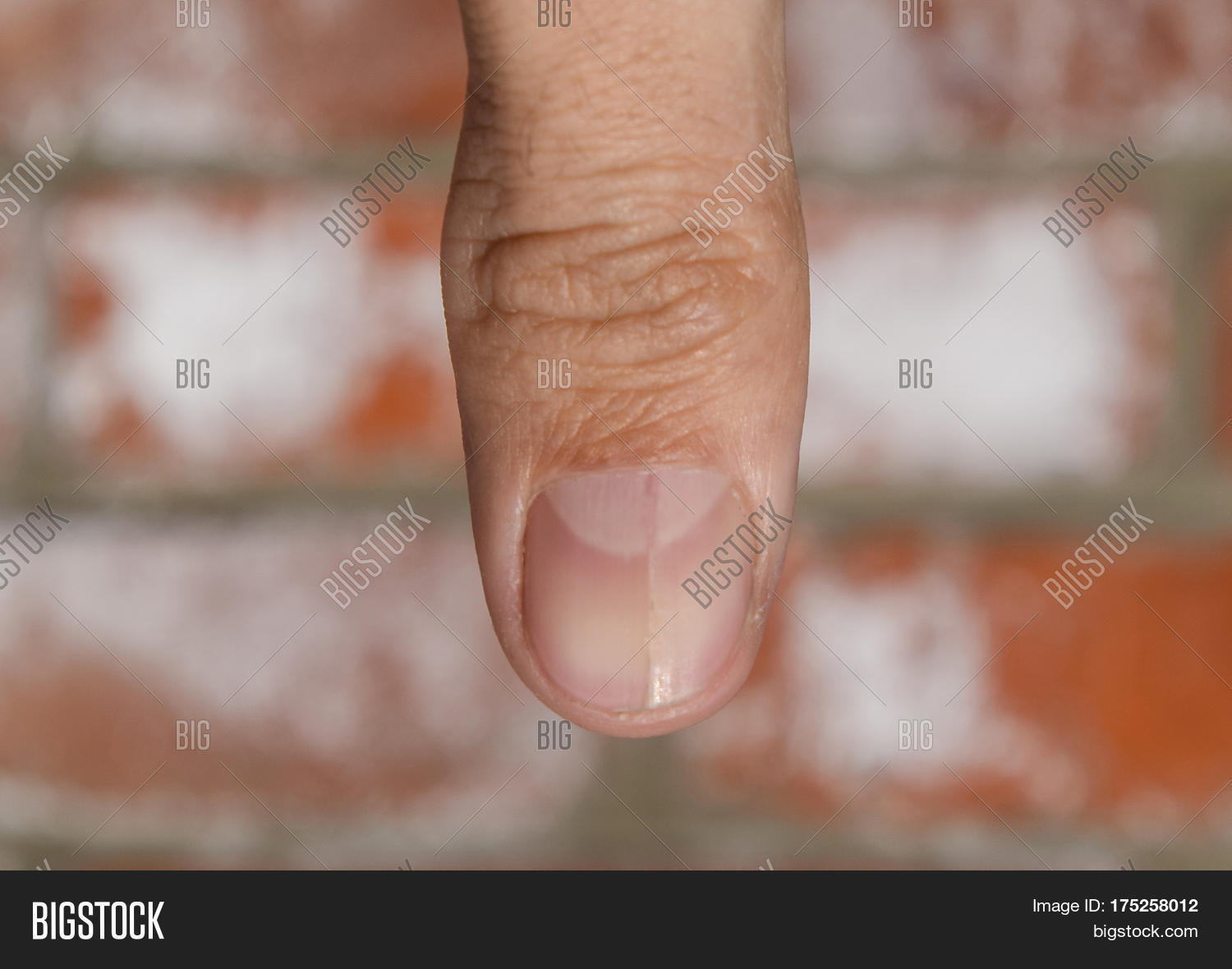 Forked Nail On Thumb. Image & Photo (Free Trial) | Bigstock