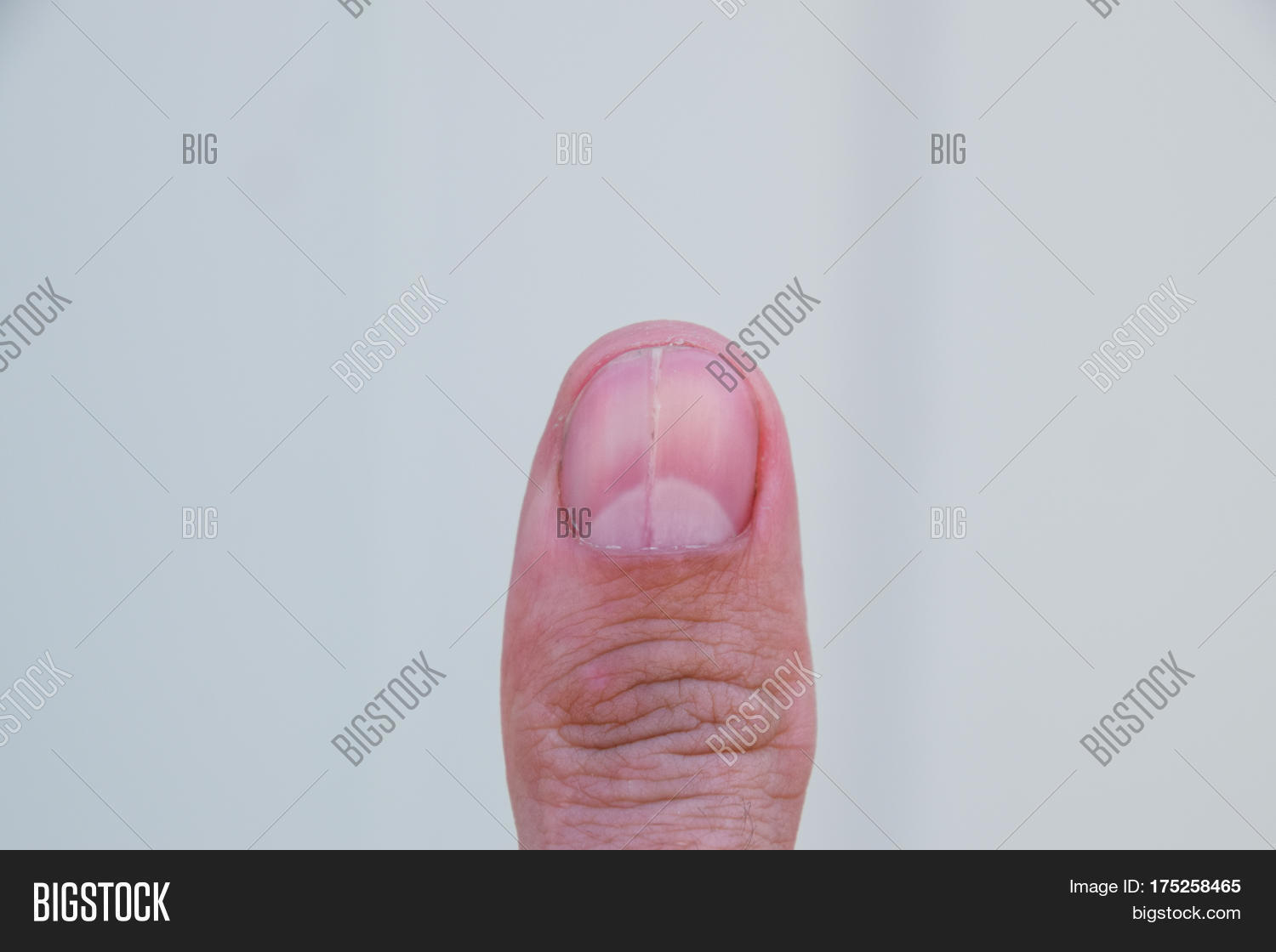 Forked Nail On Thumb. Image & Photo (Free Trial) | Bigstock