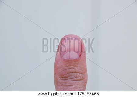 Forked Nail On Thumb. Image & Photo (Free Trial) | Bigstock