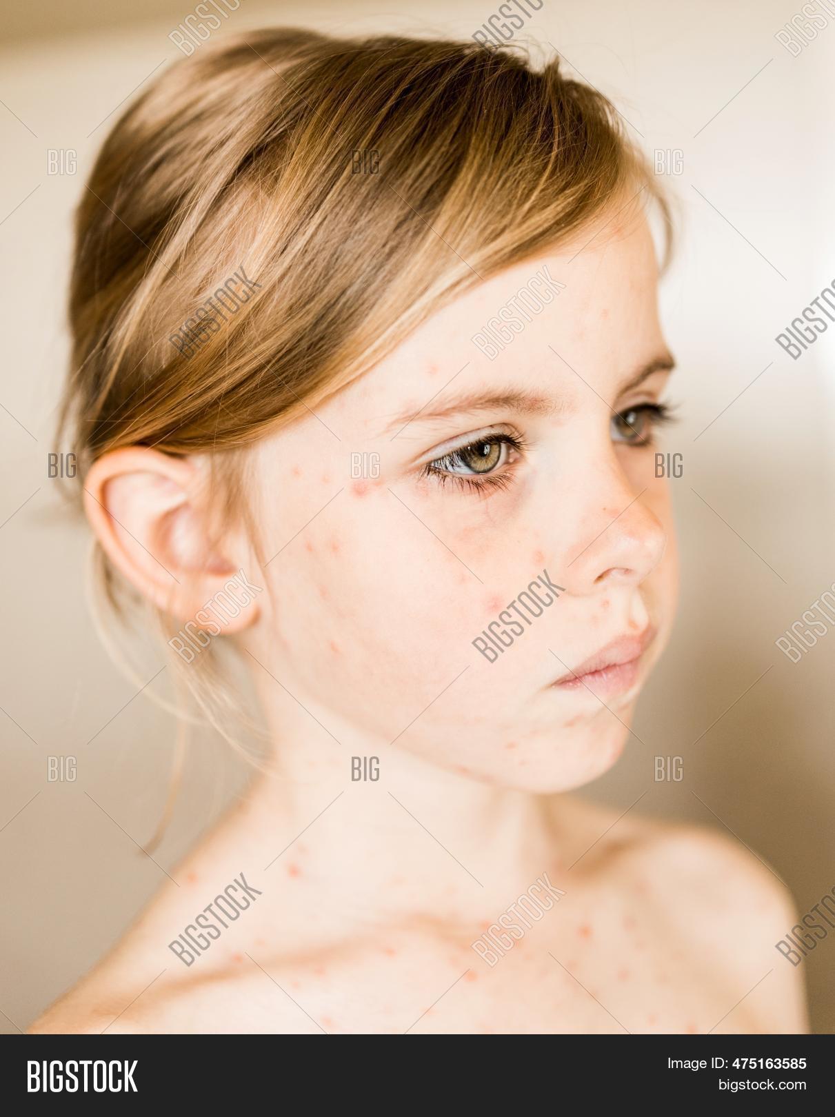 Chickenpox, Varicella Image & Photo (Free Trial) | Bigstock