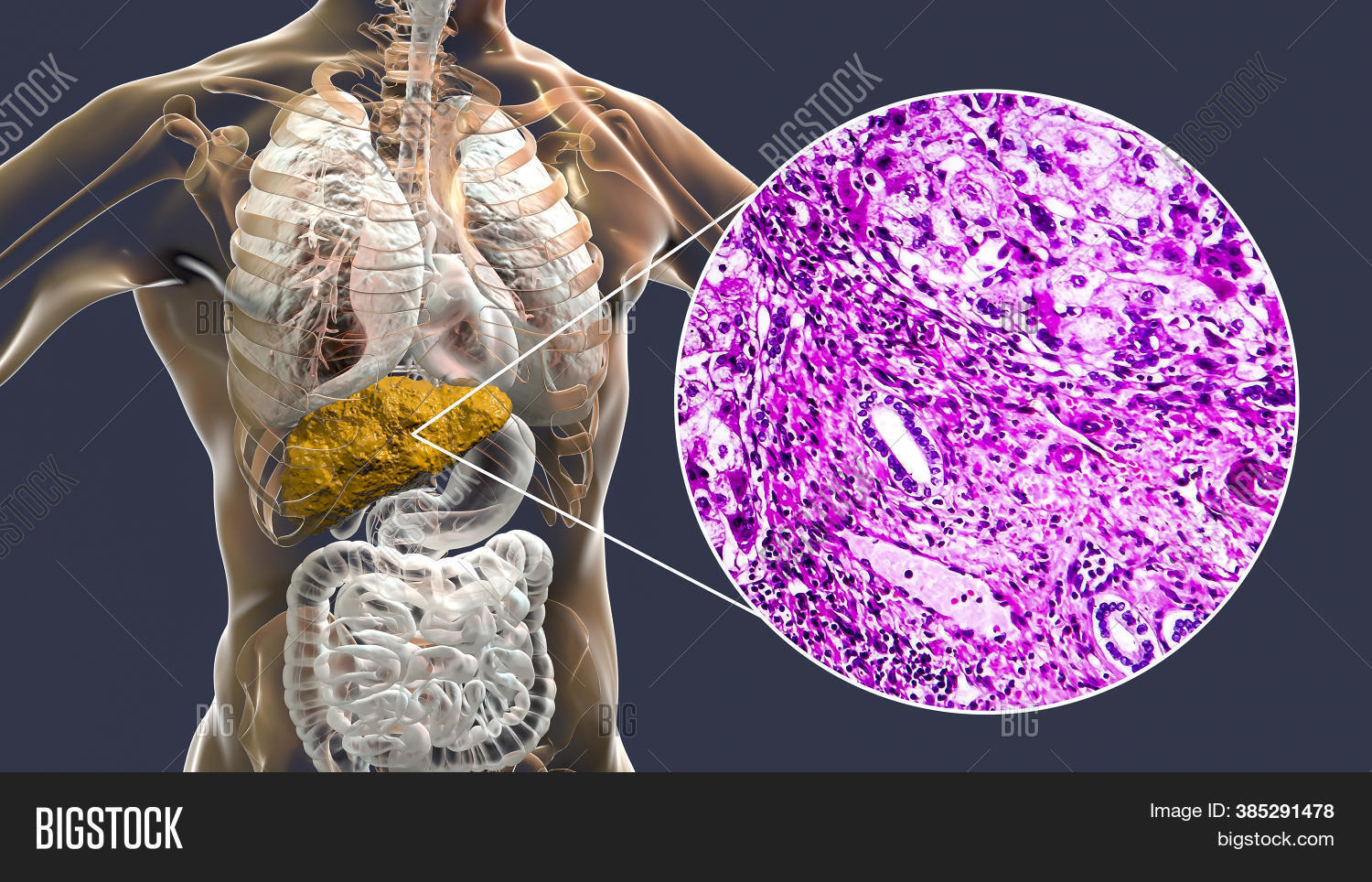 Liver Cirrhosis Inside Image & Photo (Free Trial) | Bigstock
