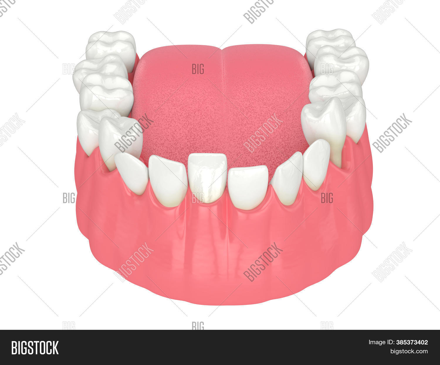 3D Render Jaw Abnormal Image & Photo (Free Trial) | Bigstock