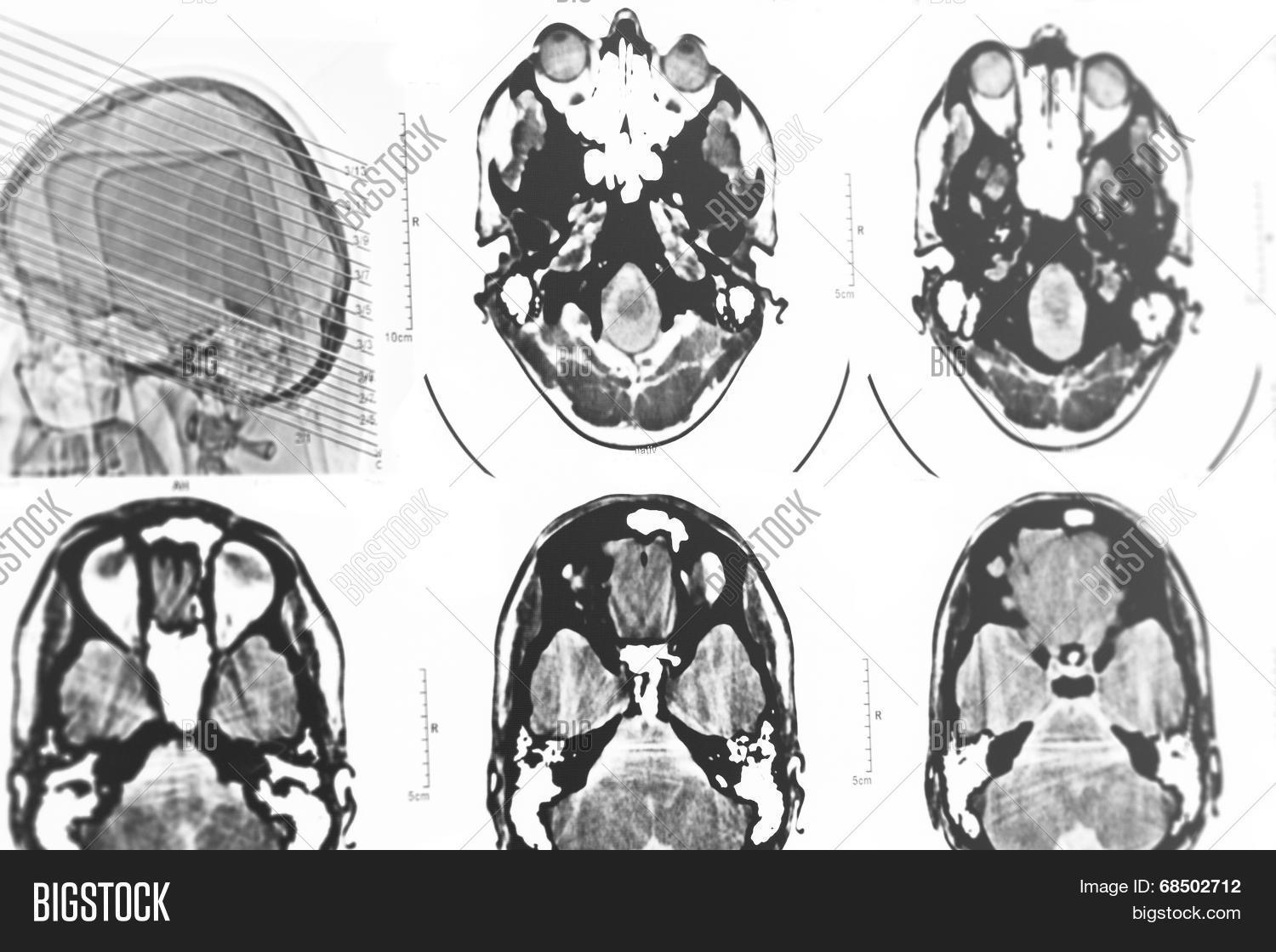 Ct Mri Skull Image & Photo (Free Trial) | Bigstock
