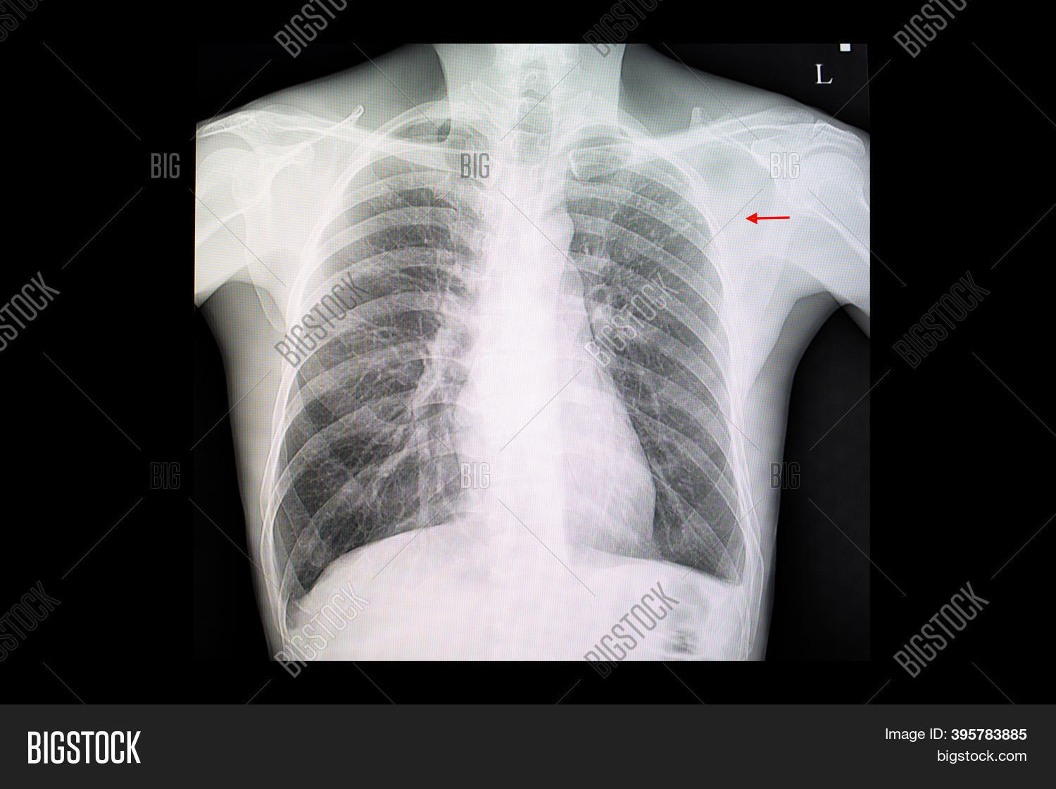 Chest X-ray Film Image & Photo (Free Trial) | Bigstock