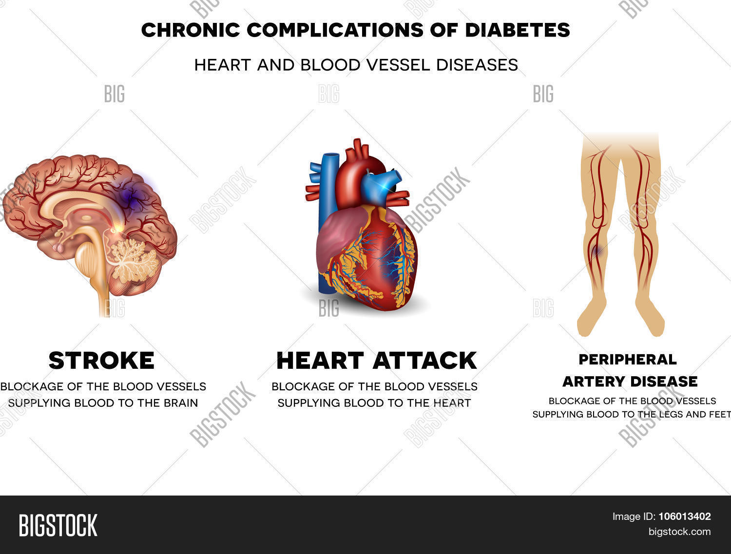 Chronic Complications Vector & Photo (Free Trial) | Bigstock