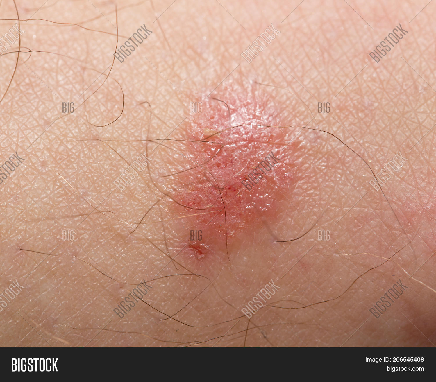 Ringworm Skin. Macro Image & Photo (Free Trial) | Bigstock
