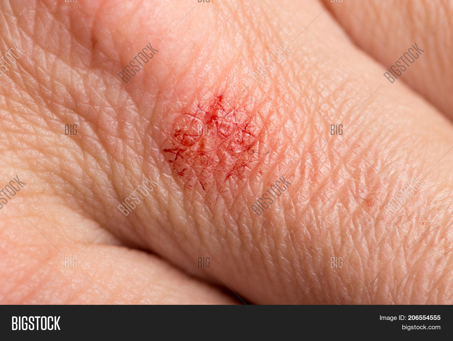Wound On Human Skin. Image & Photo (Free Trial) | Bigstock