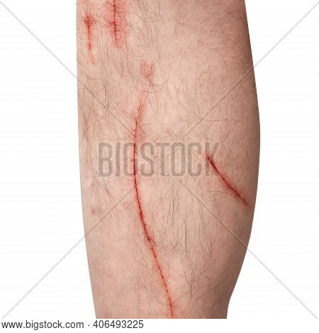 Scratch On Man's Leg. Image & Photo (Free Trial) | Bigstock