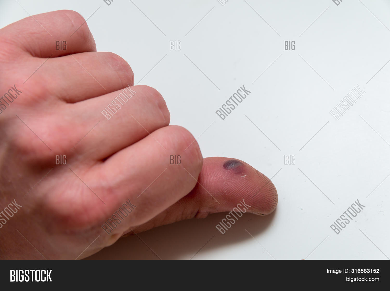 Blood Blister Under Image & Photo (Free Trial) | Bigstock