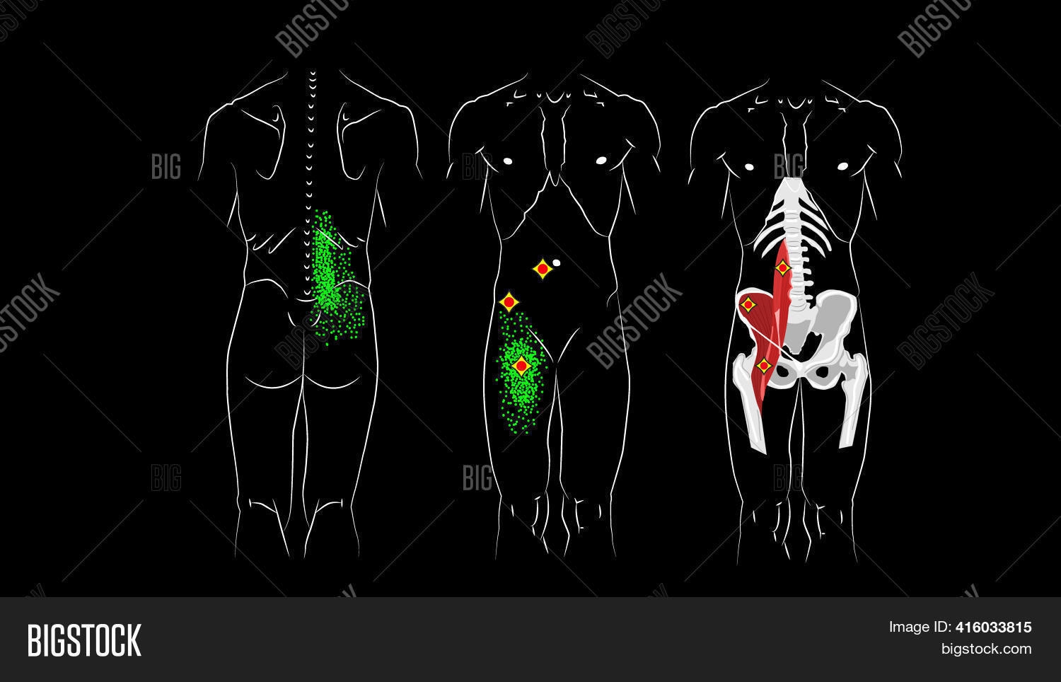 Trigger Points Image & Photo (Free Trial) | Bigstock