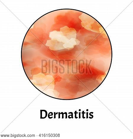 Skin Inflammation. Vector & Photo (Free Trial) | Bigstock