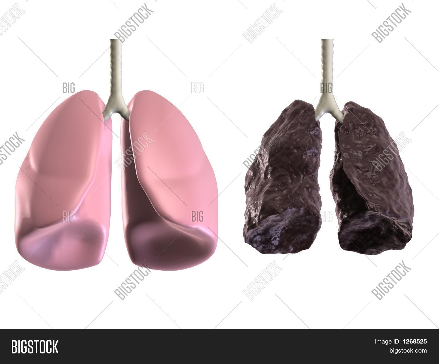 Health Bad Lung Image & Photo (Free Trial) | Bigstock