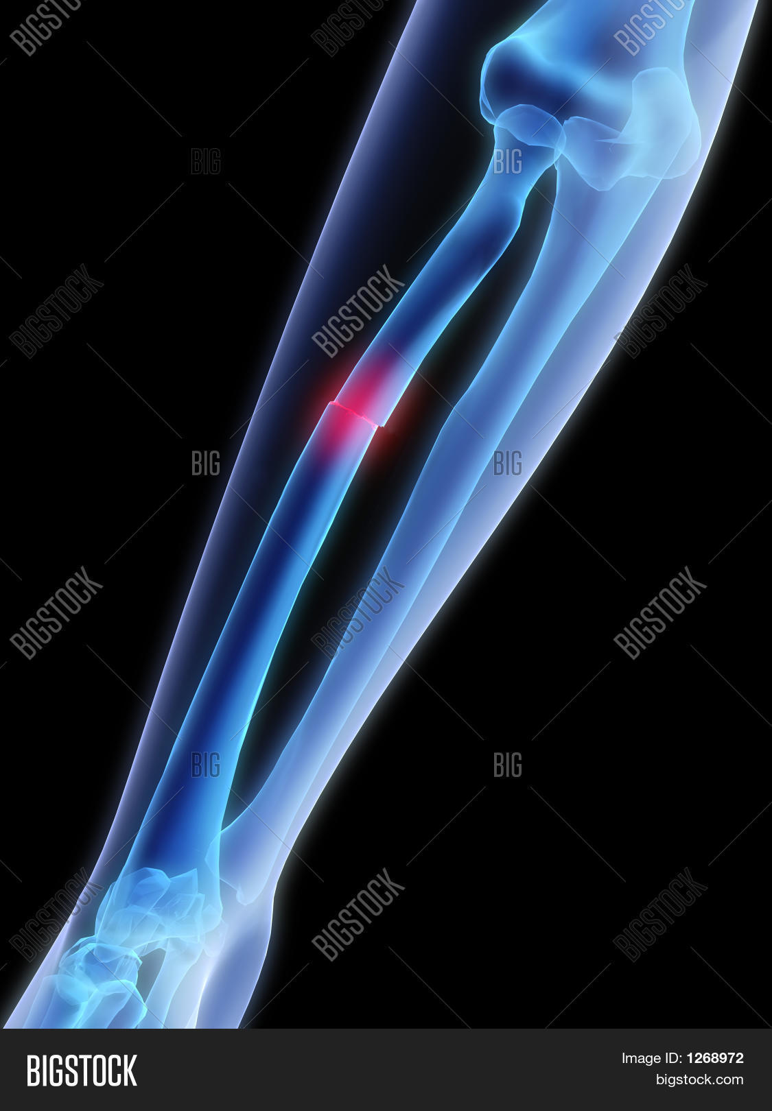 Broken Arm Image & Photo (Free Trial) | Bigstock