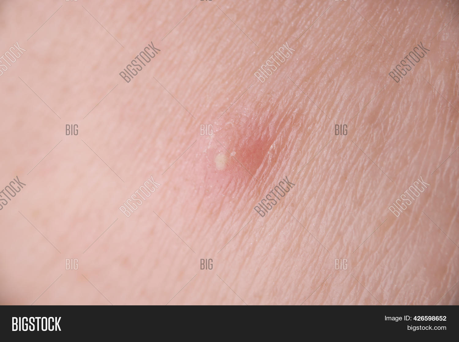White Pus Pimple On Image & Photo (Free Trial) | Bigstock