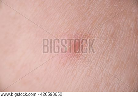 White Pus Pimple On Image & Photo (Free Trial) | Bigstock