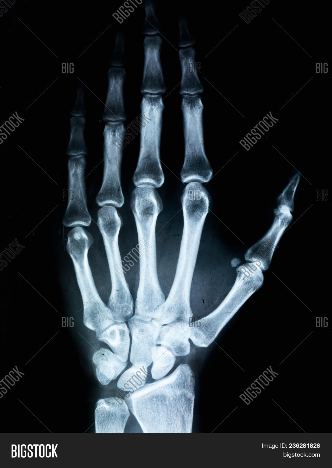 X-ray Human Hand. X- Image & Photo (Free Trial) | Bigstock
