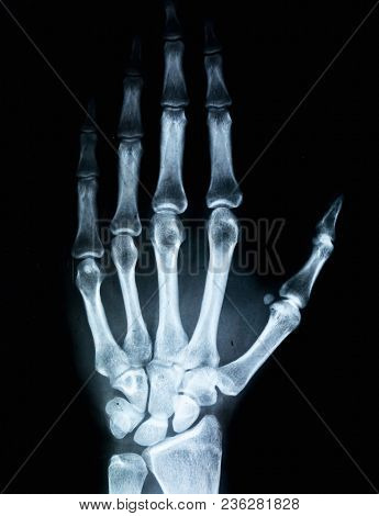 X-ray Human Hand. X- Image & Photo (Free Trial) | Bigstock