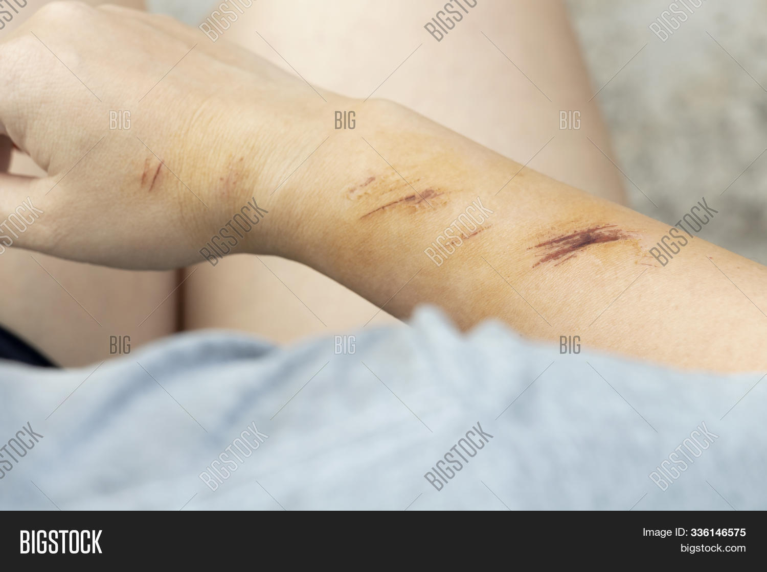 Wound Form Scabs On Image & Photo (Free Trial) | Bigstock