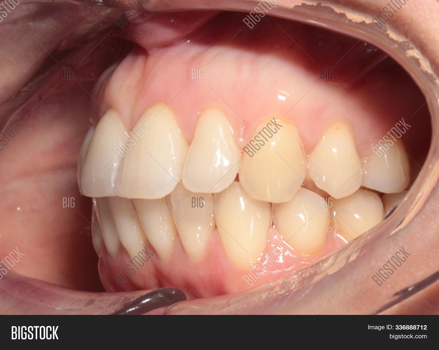 Close- Side View Teeth Image & Photo (Free Trial) | Bigstock