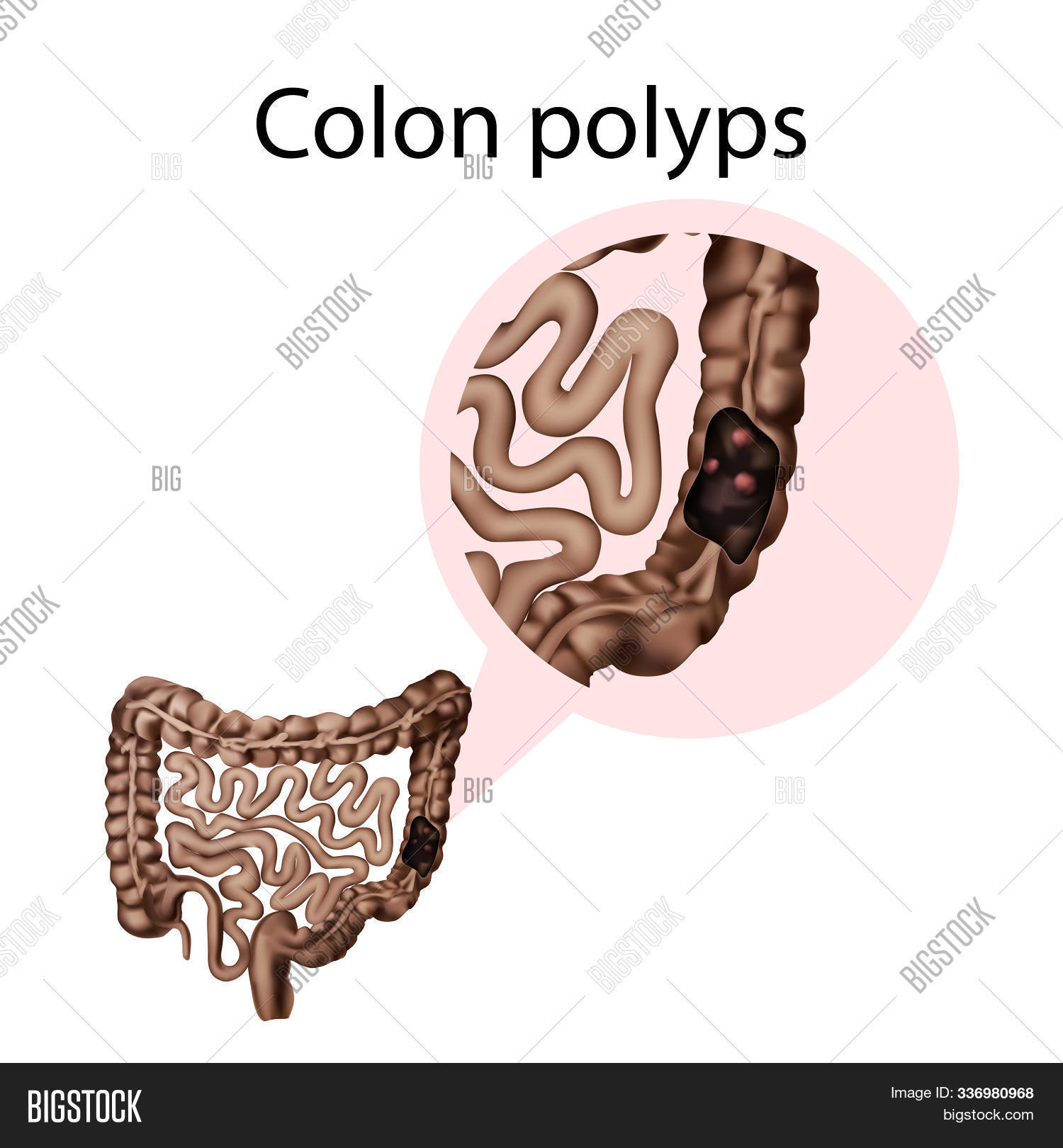 Colon Polyps. Abnormal Image & Photo (Free Trial) | Bigstock