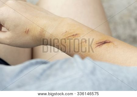 Wound Form Scabs On Image & Photo (Free Trial) | Bigstock