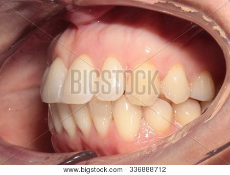 Close- Side View Teeth Image & Photo (Free Trial) | Bigstock